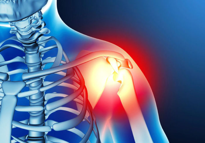 Shoulder Replacement Central Florida Orthopedic Doctor Near Me