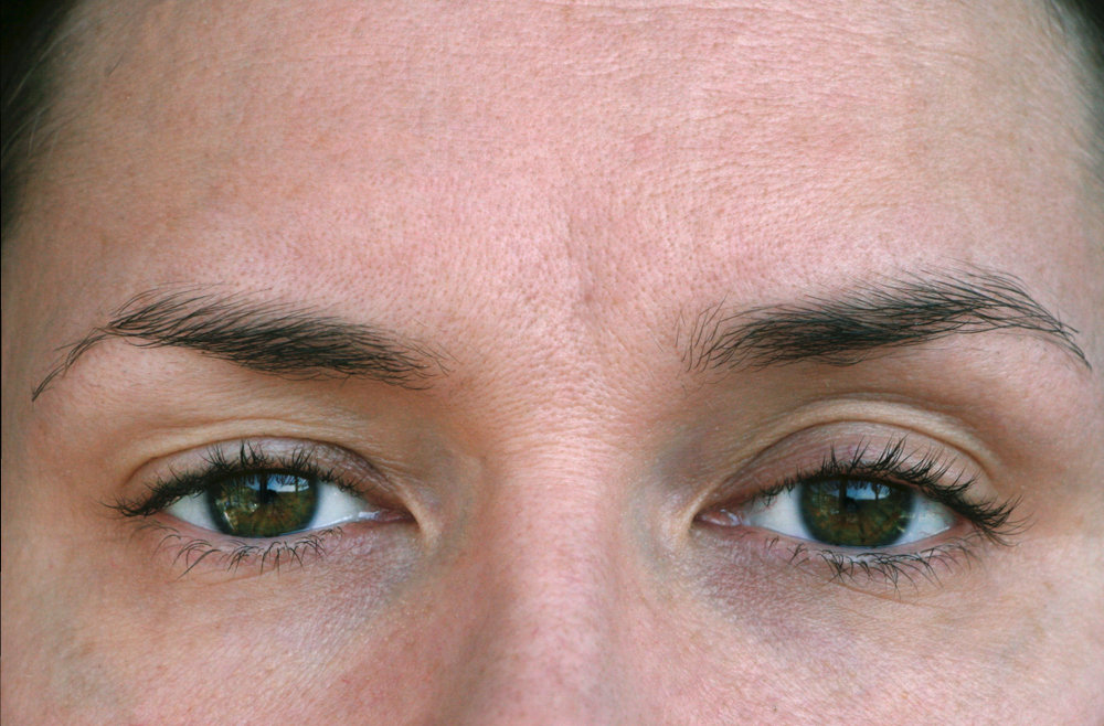Frontalis Sling For Ptosis