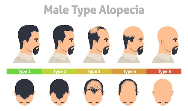 From Bald to Bold: Hair Transplant for Male Pattern Baldness