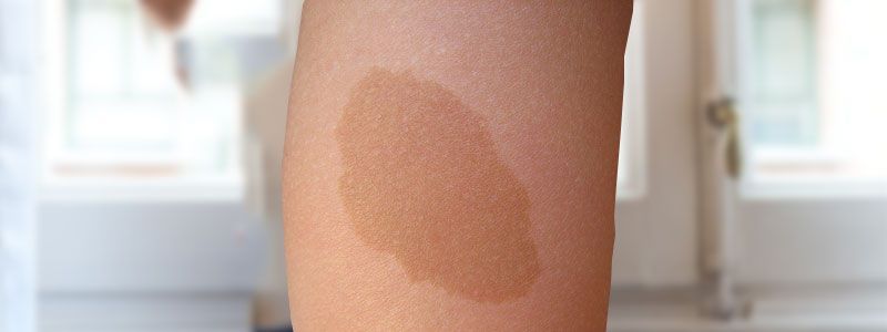 Best Treatment Options for Pigmented Birthmarks | Dubai Cosmetic Surgery®