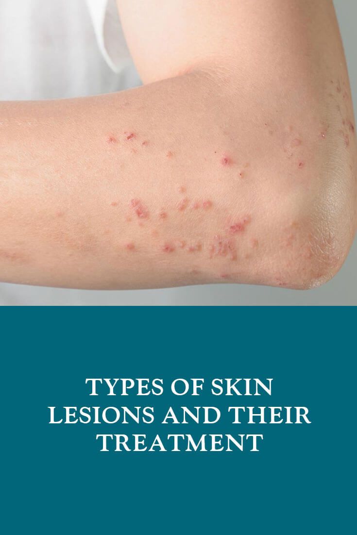 Types Of Skin Lesions And Their Treatment Dubai Cosmetic Surgery Types Of Skin Lesions And Their Treatment Dubai Cosmetic Surgery