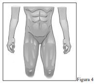 Lonquex (Lipegfilgrastim) 10mg/ml - Bula do paciente | Farmaindex