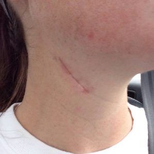 Post-Surgical Scars Treatment in Dubai & Abu Dhabi - Skin Care