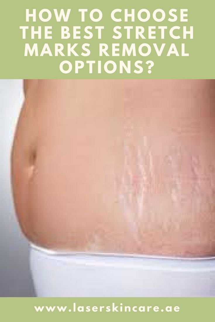 How To Choose The Best Stretch Marks Removal Options