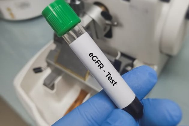 EGFR Testi Nedir? EGFR Düşüklüğü ve Yüksekliği Nedir? | Anadolu Sağlık ...