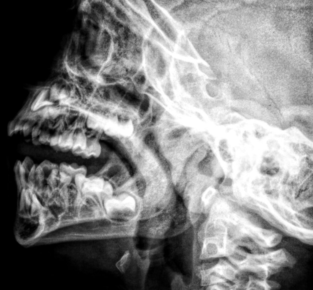 How Do Brain Injuries Occur During Car Crashes in San Francisco?