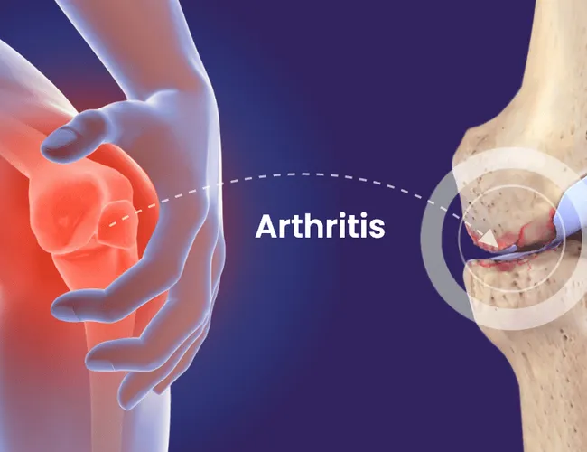 Comprehensive Guide to Arthritis: Symptoms, Causes, and Physiotherapy ...