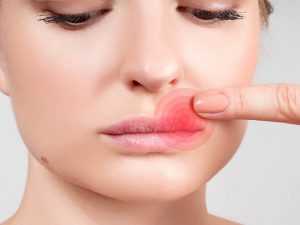 Kenali Tahapan Dan Penyebab Penyakit Herpes Sebelum Terlambat!