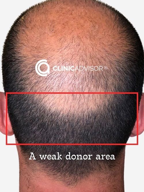 What is the Donor Area in Hair Transplants? | ClinicAdvisor®