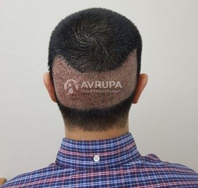 What is an Unshaven Hair Transplant and is it Effective? | ClinicAdvisor®