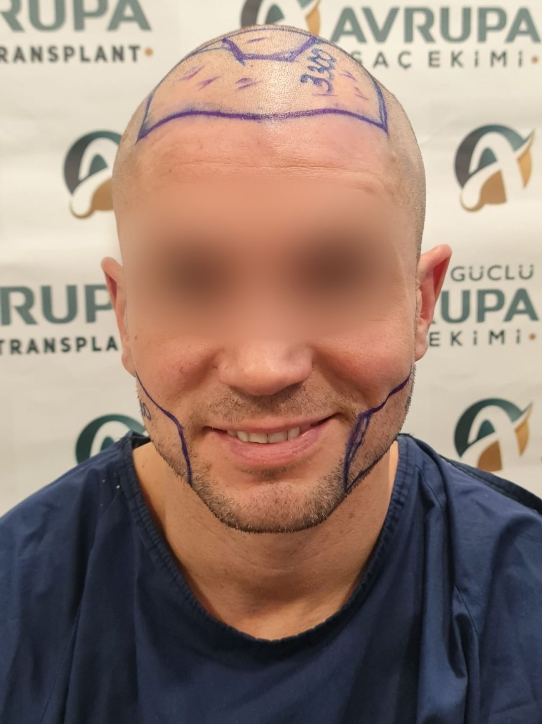 Here is My Hair Transplant Turkey Review [Photos Included] | ClinicAdvisor®