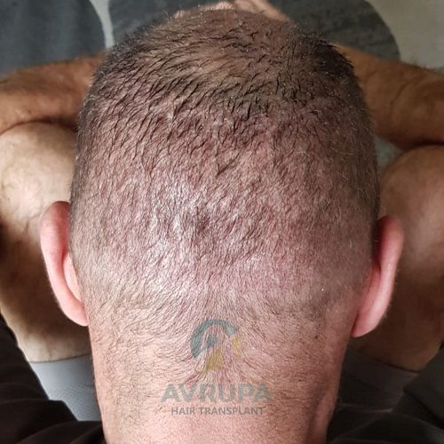 What is the Donor Area in Hair Transplants? | ClinicAdvisor®