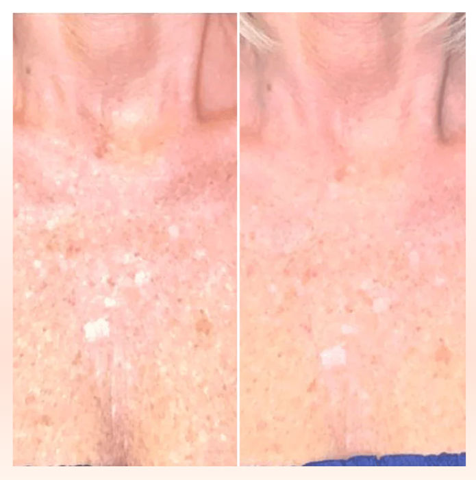 Does Omnilux Work? 2026 Evidence-Based Wrinkle Results