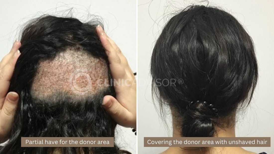 Do You Have to Shave Your Head for a Hair Transplant in Turkey ...