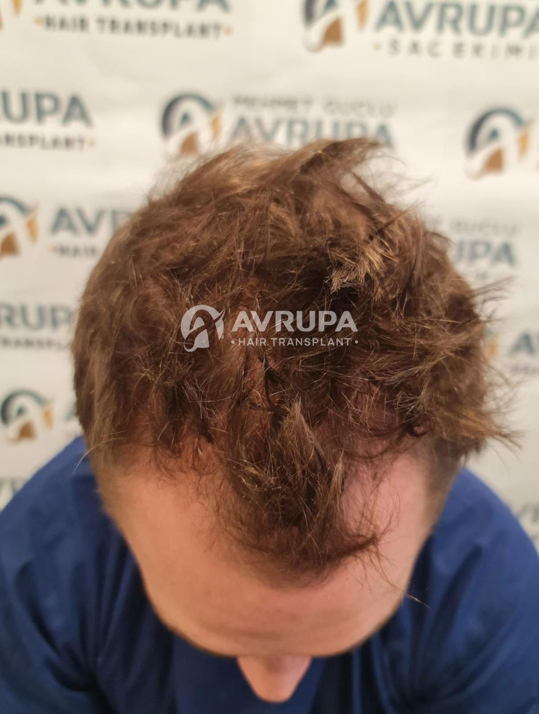 Here is My Hair Transplant Turkey Review [Photos Included] | ClinicAdvisor®