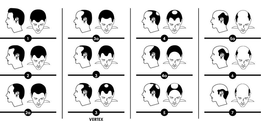 Male Pattern Baldness: Causes and Treatments | ClinicAdvisor®