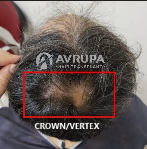 Your Ultimate Guide to Crown Hair Transplant | ClinicAdvisor®