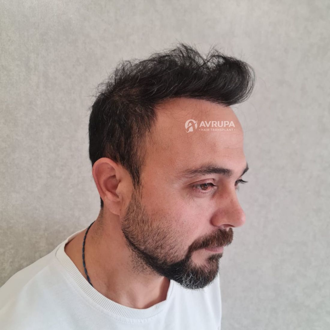 I Tried it and This is Why Hair Transplant is Better in Turkey ...