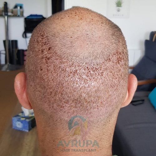 What is the Donor Area in Hair Transplants? | ClinicAdvisor®