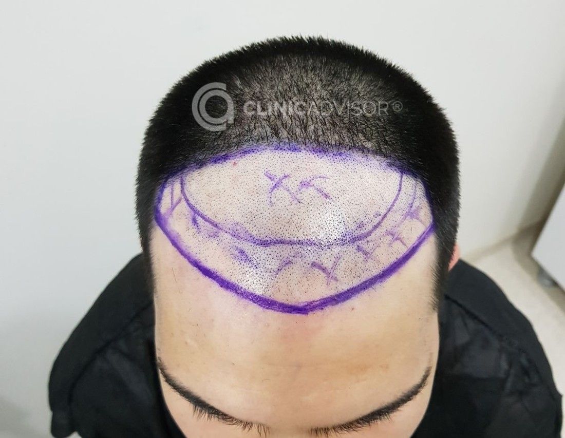 Do You Have to Shave Your Head for a Hair Transplant in Turkey ...