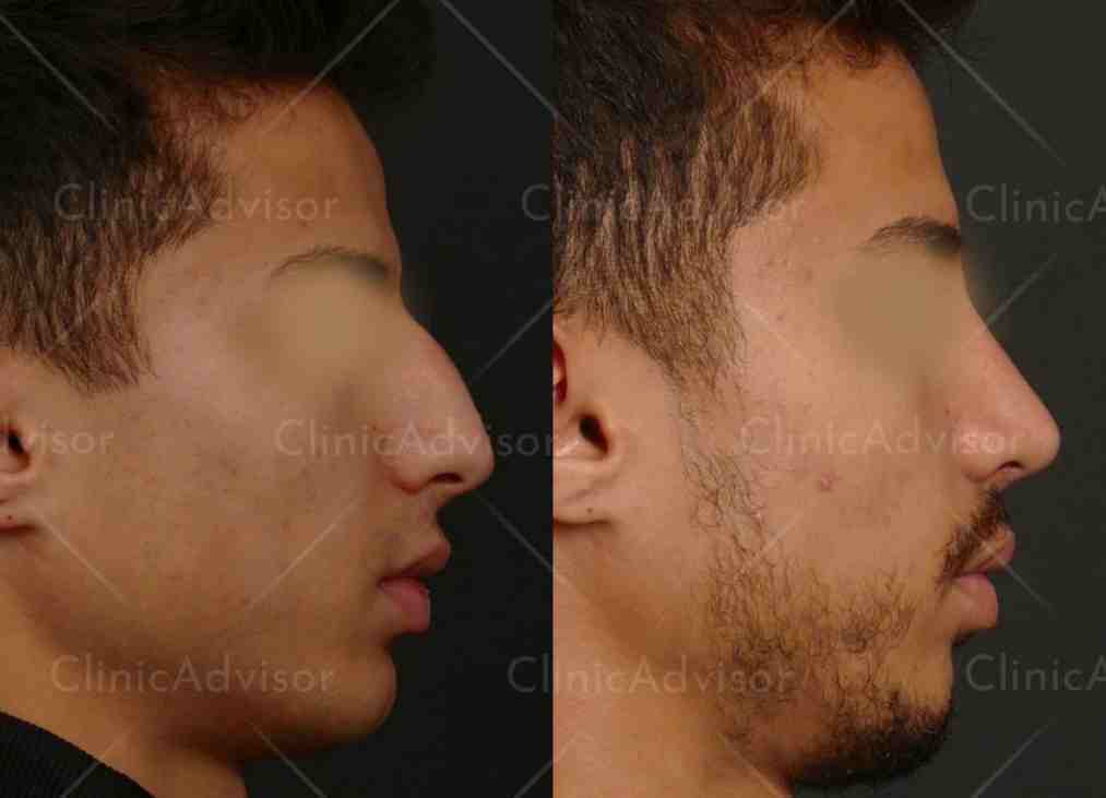 Rhinoplasty Cost in Turkey: Ultimate Guide for 2023 Price Comparison