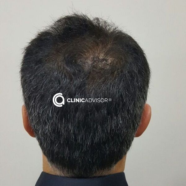 What is the Donor Area in Hair Transplants? | ClinicAdvisor®