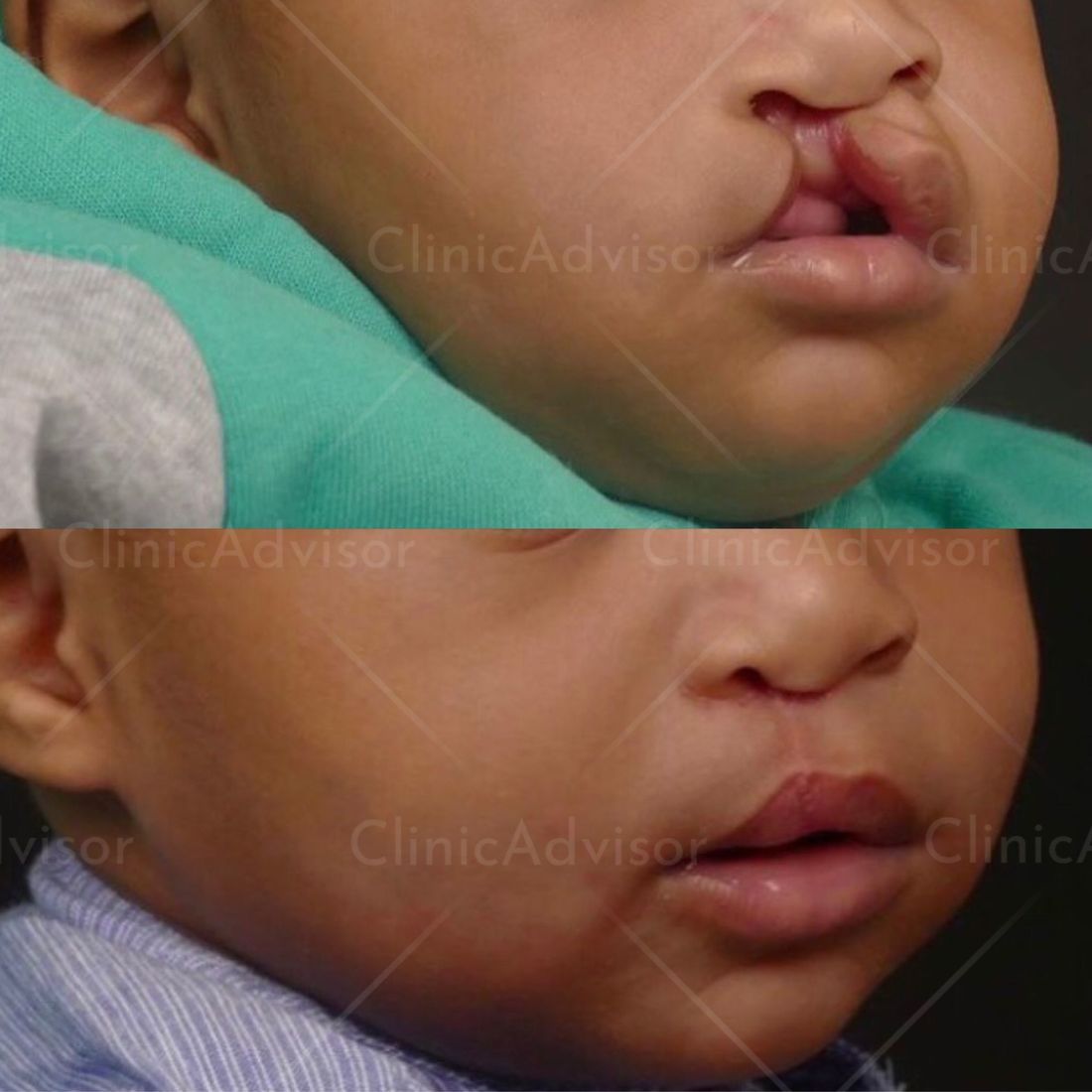 Cleft Lip & Cleft Palate Treatment in Turkey with ClinicAdvisor ...