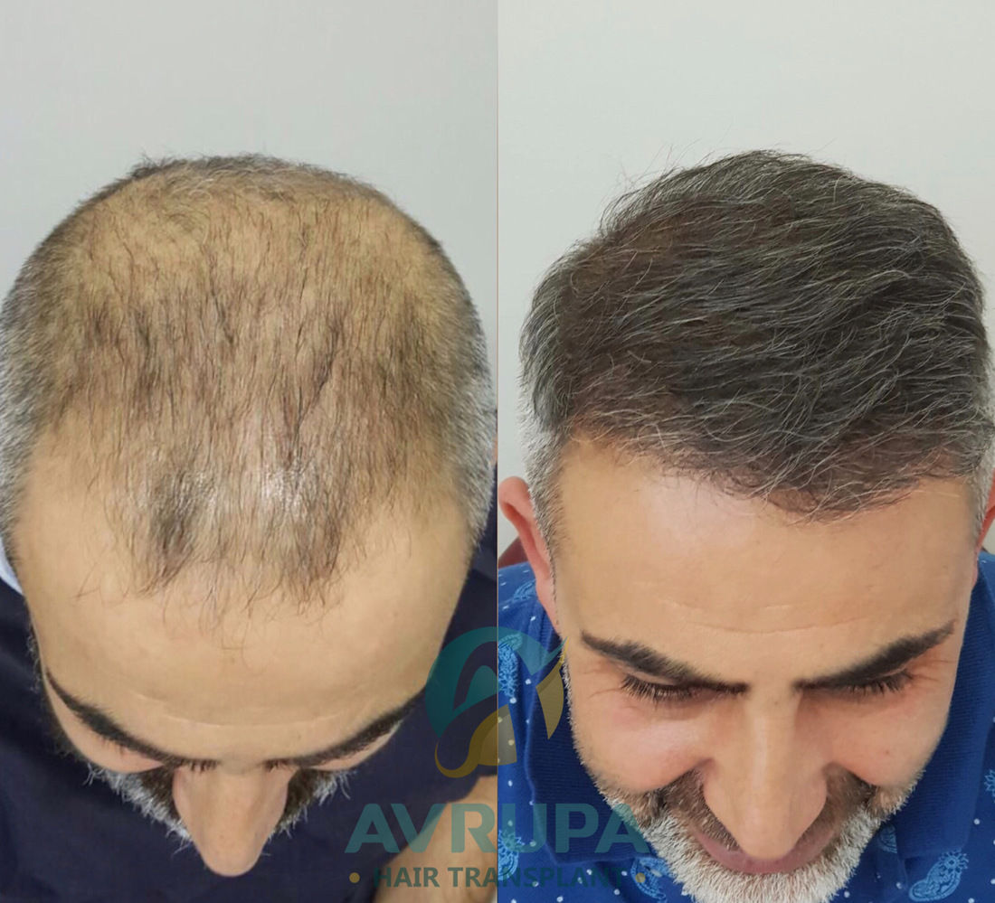 FUE Hair Transplant Results : 10 Real Cases With Photos - Clinic Advisor