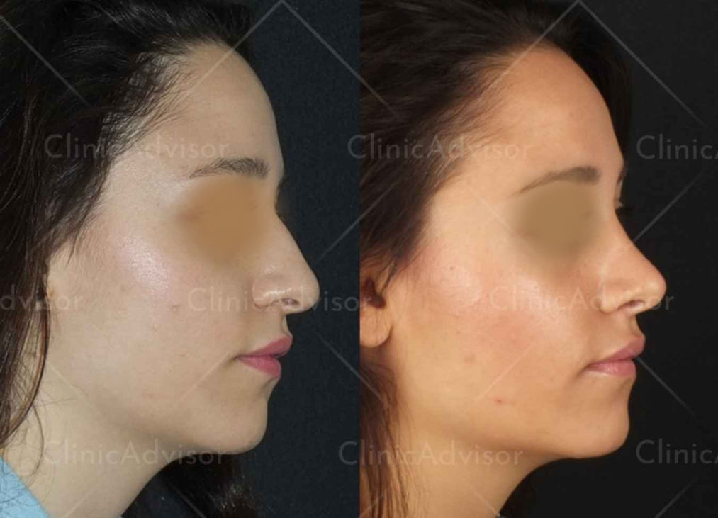 Rhinoplasty Cost in Turkey: Ultimate Guide for 2023 Price Comparison