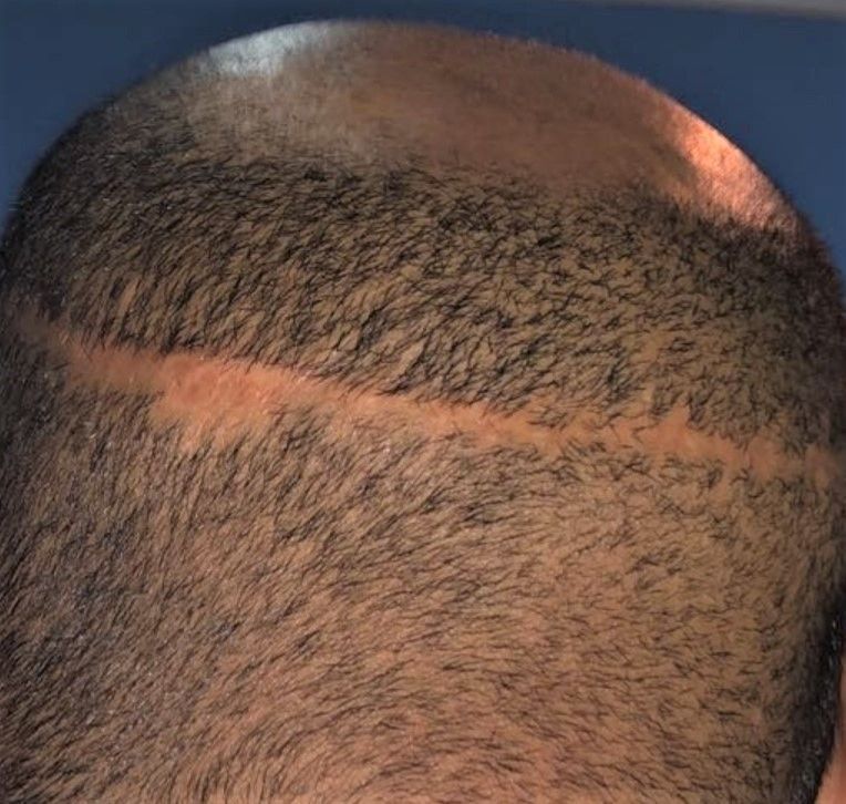 Hair Transplant Infection: Causes, Symptoms, Prevention & Treatment ...