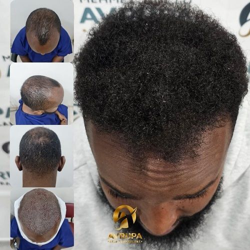 Afro Hair Types Explained: 4a, 4b, and 4c | ClinicAdvisor®