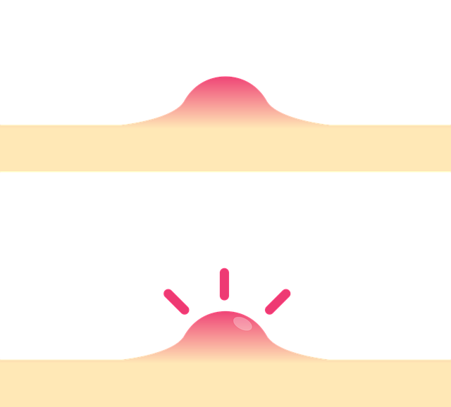 Understanding Acne-Prone Skin: Causes and Types