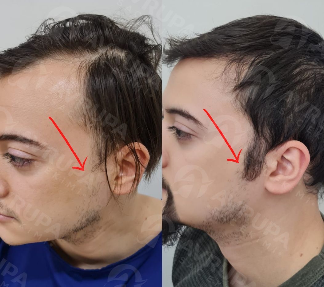 Sideburn Hair transplants: Everything You Need To Know | ClinicAdvisor®