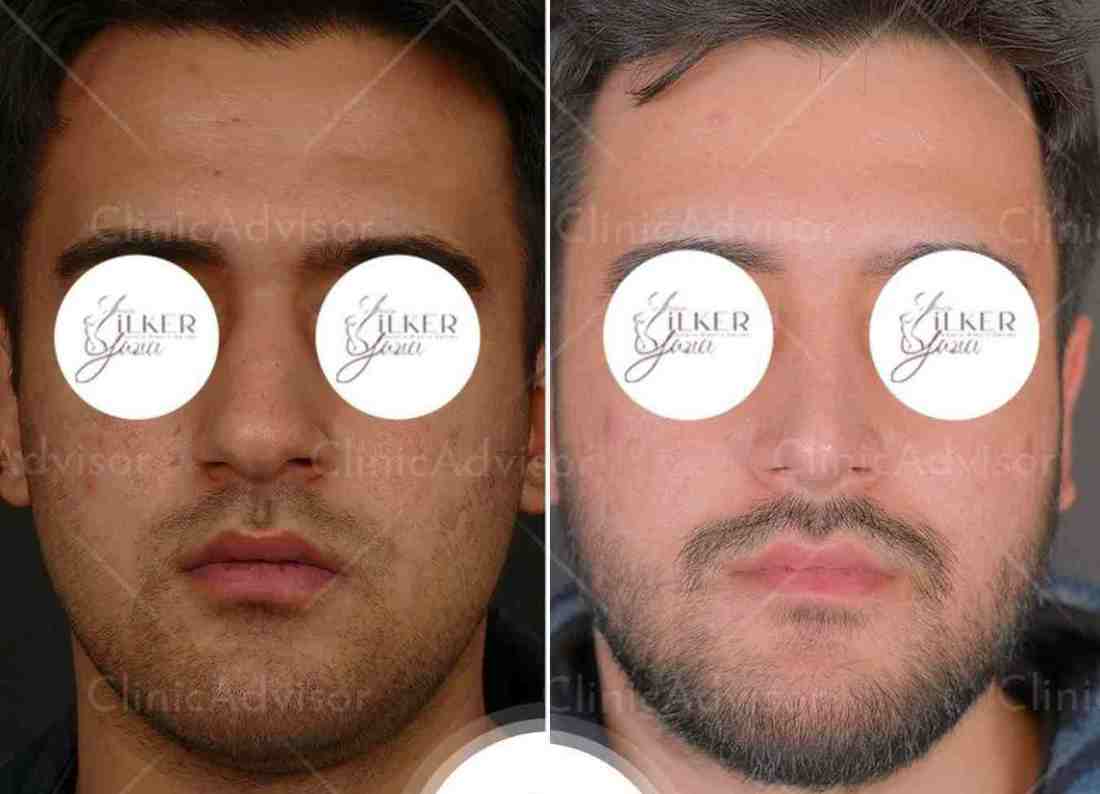 Rhinoplasty Cost in Turkey: Ultimate Guide for 2023 Price Comparison