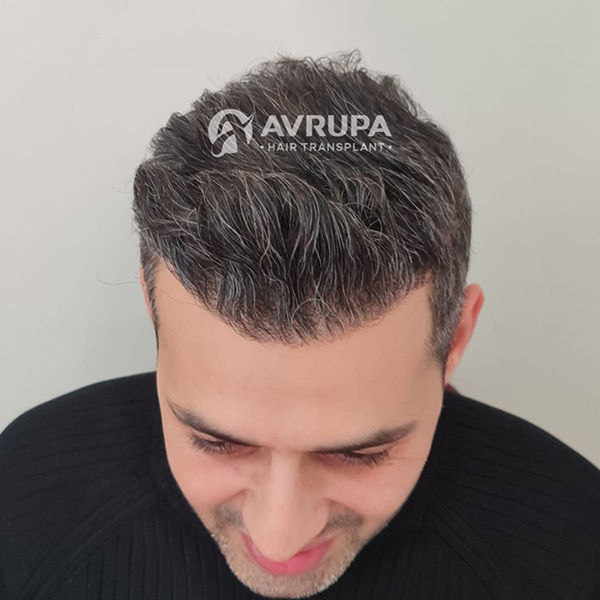 Botched Hair Transplant Fixed by Avrupa Hair Transplant | Clinicadvisor®