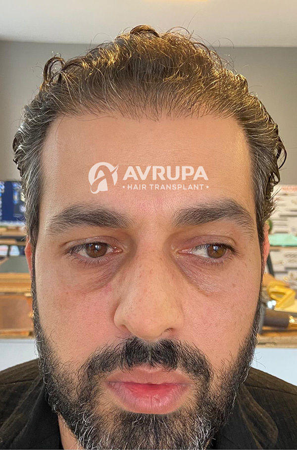 Botched Hair Transplant Fixed by Avrupa Hair Transplant | Clinicadvisor®