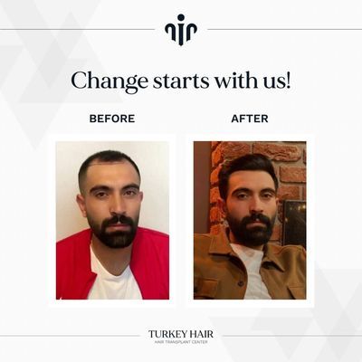 Before & Afters - Photo Album By Turkey Hair Transplant Center