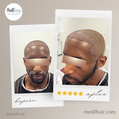 Turkish hair transplants - Photo Album By Medil Hair Turkish Hair ...