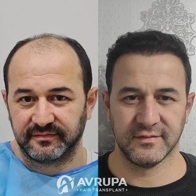 Before and After Hair Transplant in Turkey - Hair Transplant Case ...