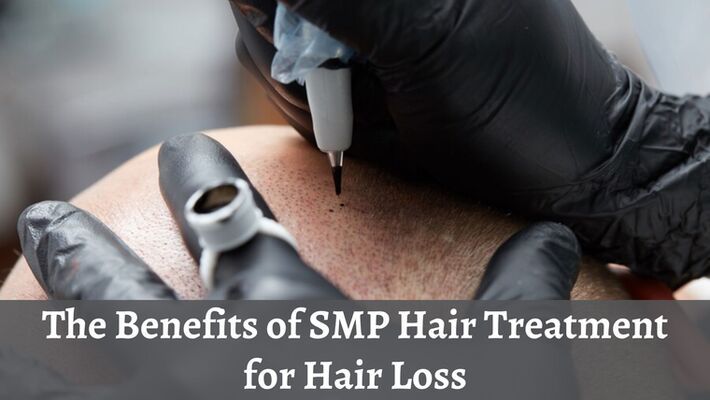 The Benefits of SMP Hair Treatment for Hair Loss - Photo Album By ...