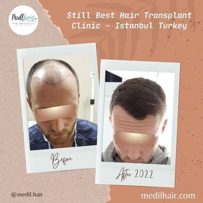 Turkish hair transplants - Photo Album By Medil Hair Turkish Hair ...