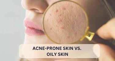 The Ultimate Skincare Routine for Acne-Prone Skin