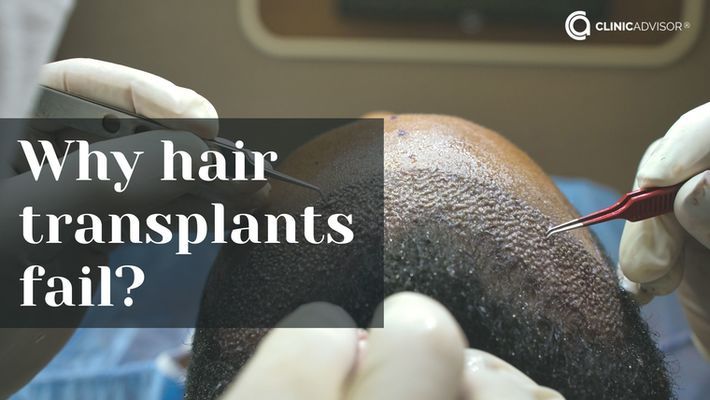 5 Reasons Why Hair Transplants Fail | ClinicAdvisor®