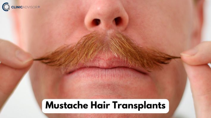 Mustache hair Transplants : Everything You Need to Know | ClinicAdvisor®