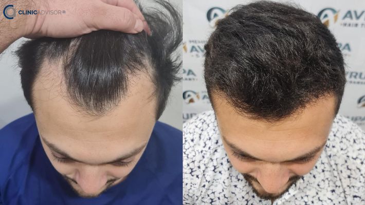 I have Tried Hair Transplant in Turkey and Thank God for the Great ...