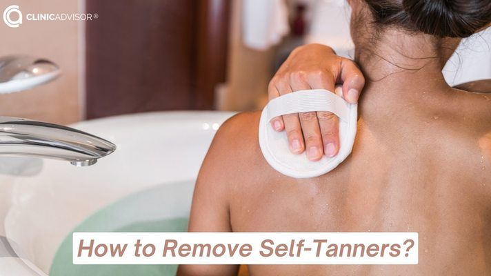 Dermatologist's Tips on Removing Self Tanner (Sunless Tanner)
