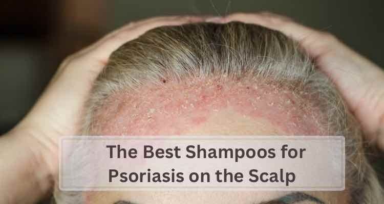 The Best Shampoos for Psoriasis on the Scalp | ClinicAdvisor®