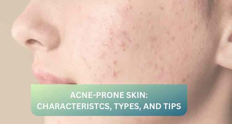 Understanding Acne-Prone Skin: Causes and Types