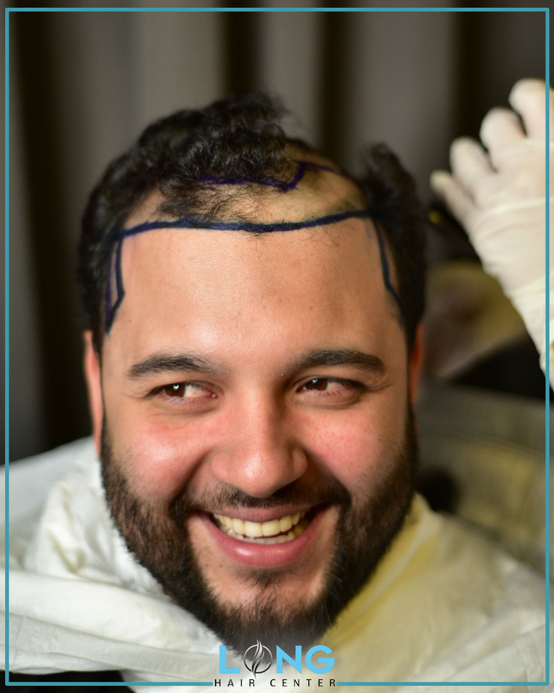 Photo shows designing the hairline for a patient at Long Hair Center in ...