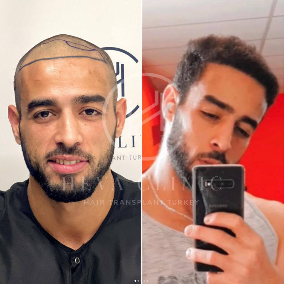 3200 Grafts Before After | Heva Clinic Turkey - Heva Clinic